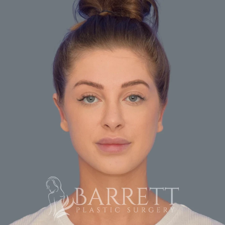 Ear Surgery Before and After Photos